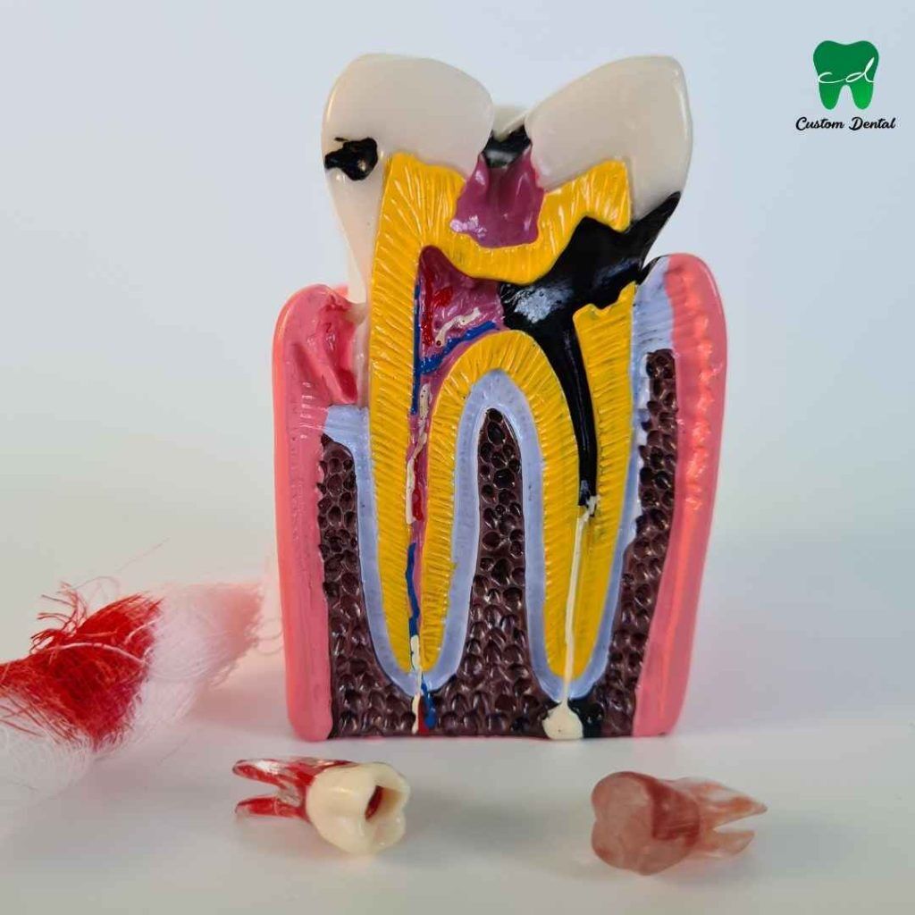 Etapas De La Caries Dental 471x366