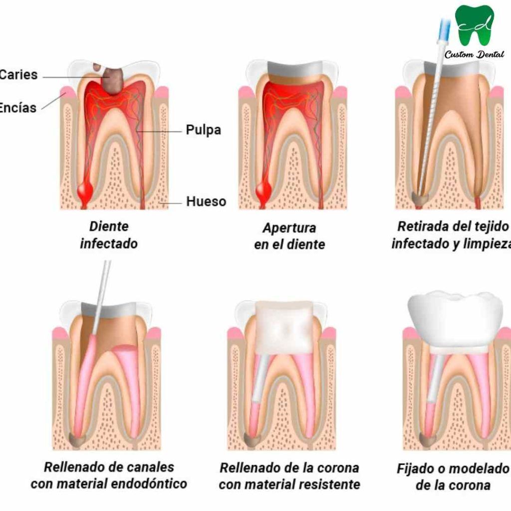 Endodoncia. Que hacer para prevenirla. Custom Dental